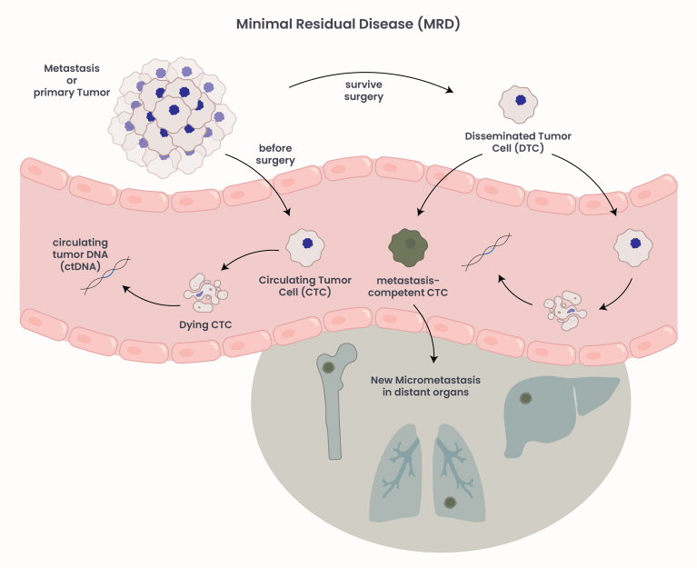 Living Beyond Cancer: What is Minimal Residual Disease (MRD) and How to ...